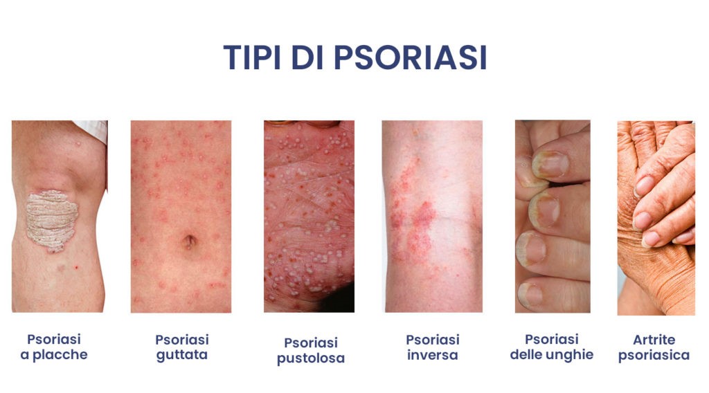 PSORIASI: COS'È, CAUSE E RIMEDI | Granfarma
